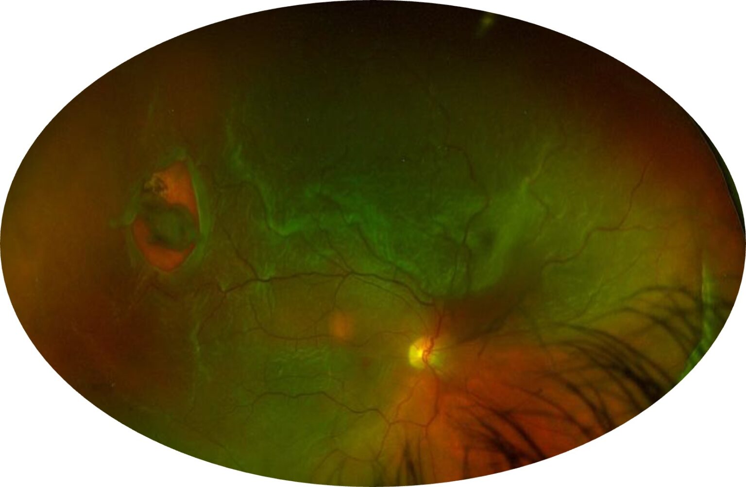 Décollement de la rétine : causes et traitements - COMR