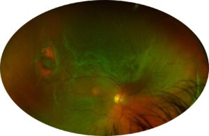 Décollement de la rétine : causes et traitements - COMR